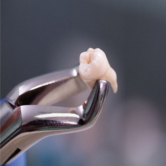 Dental tooth extractions without pain in Smile Anatomy Center